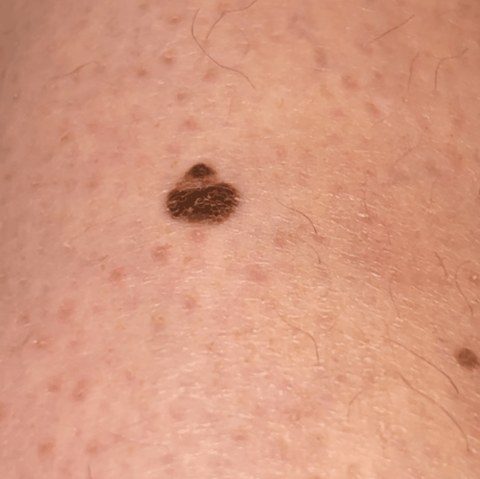 Medicash marks milestone of 1,000th skin cancer detected via SkinVision ...